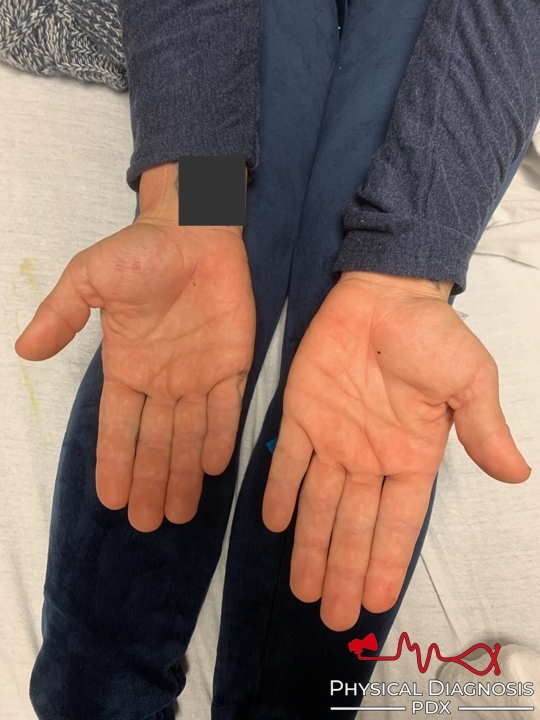 Soft tissue enlargement - Physical Diagnosis PDX